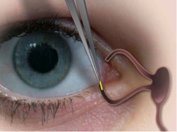 Dry Eyes: Symptoms, Causes, & Treatment | Milan Eye Center